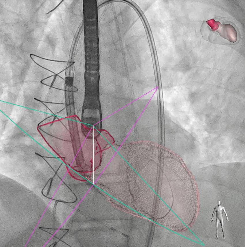 La cardiologie au coeur de la recherche: nouvelles stratégies dans la ...